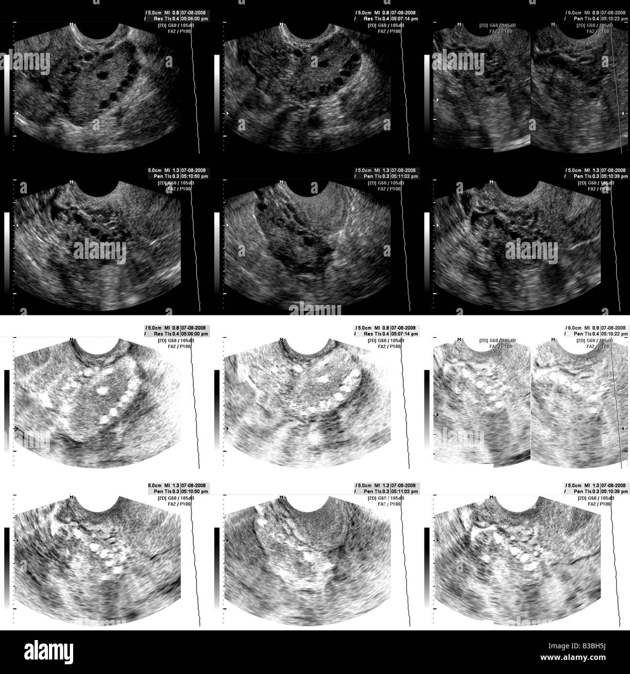 Ovaries showing signs of bead of pearls as seen in poyicystic ovary ...