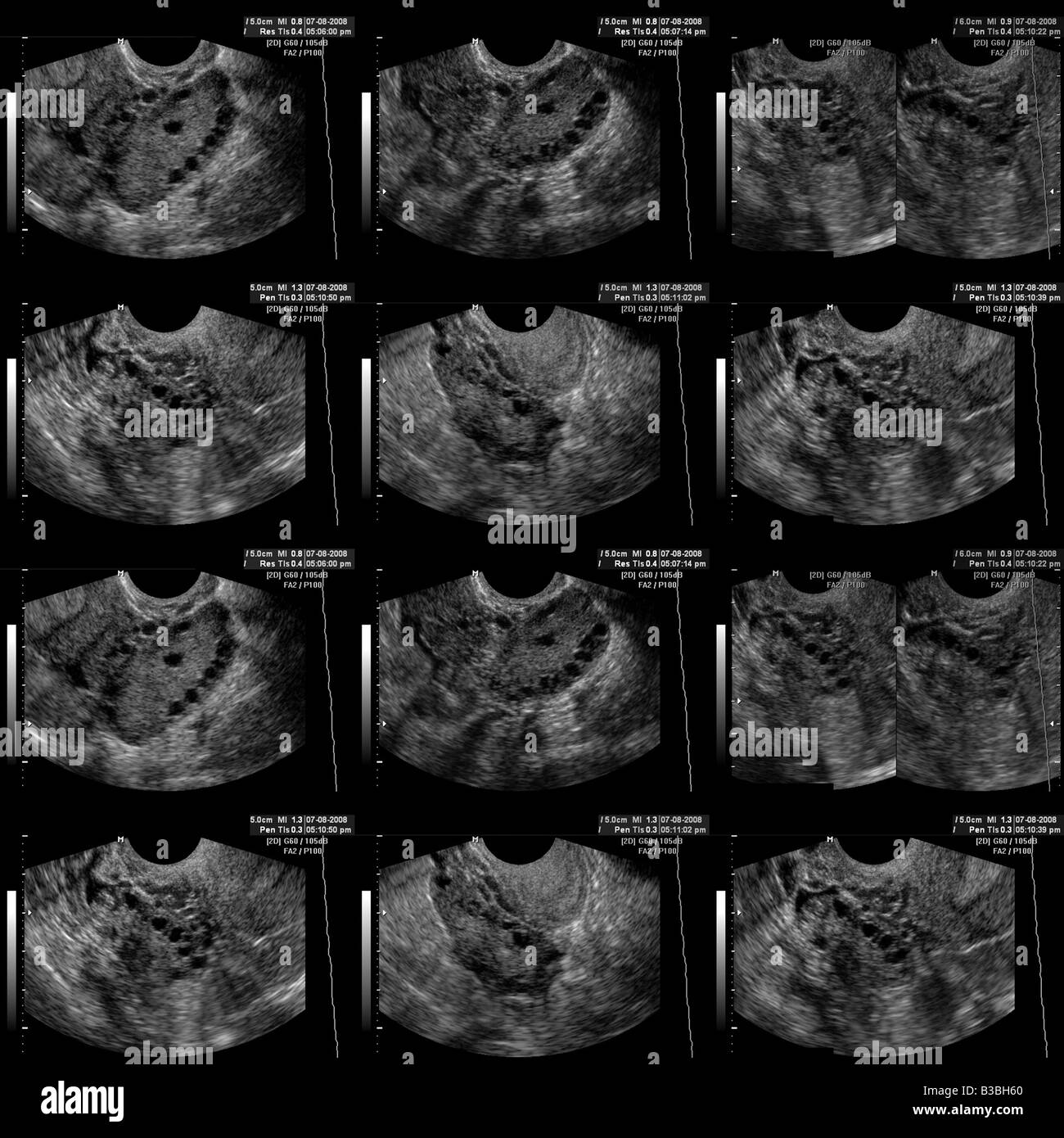 Ovaries showing signs of bead of pearls as seen in poyicystic ovary ...
