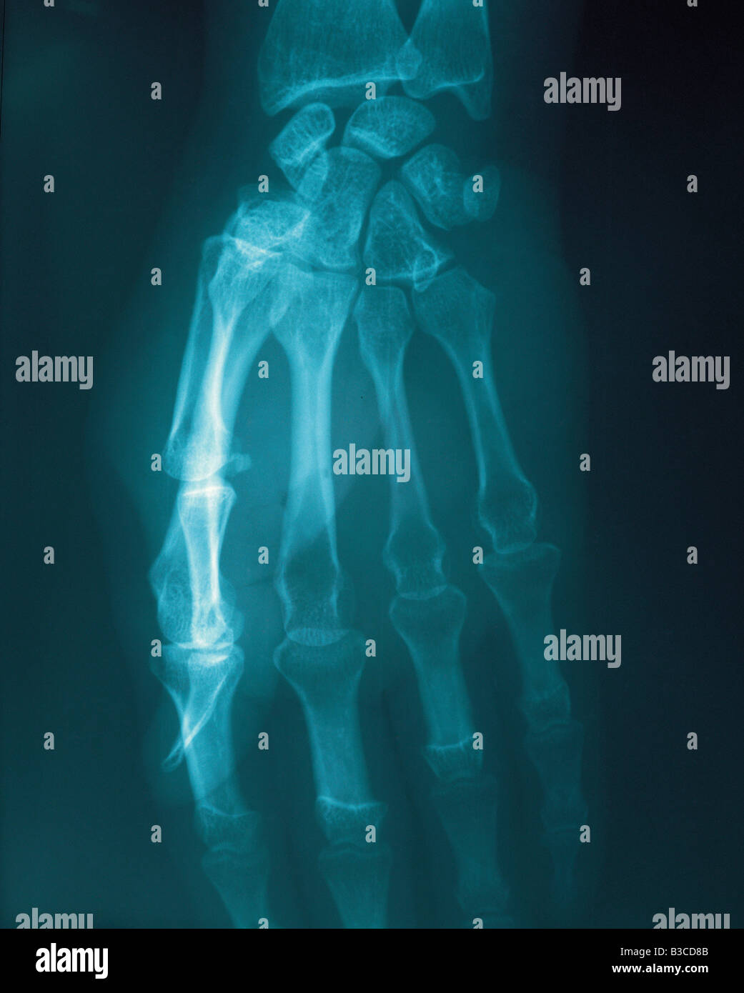 Human bones radiography scan image hi-res stock photography and images ...