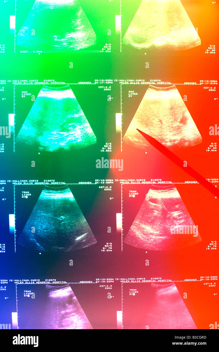 color coded ultrasound of female chest Stock Photo - Alamy