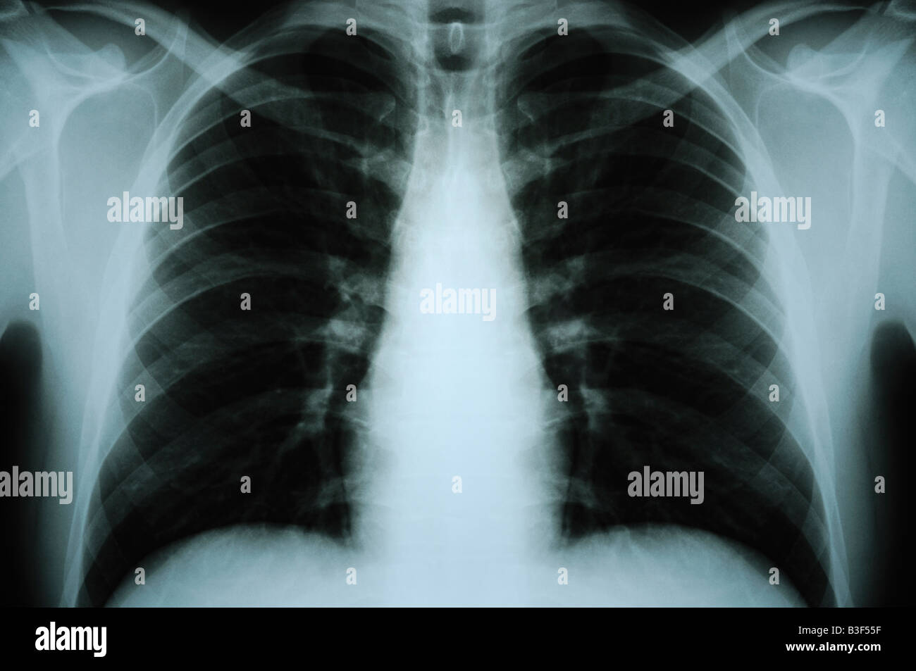 Chest X Ray of a an Adult Human Male Digitally Altered to be ...
