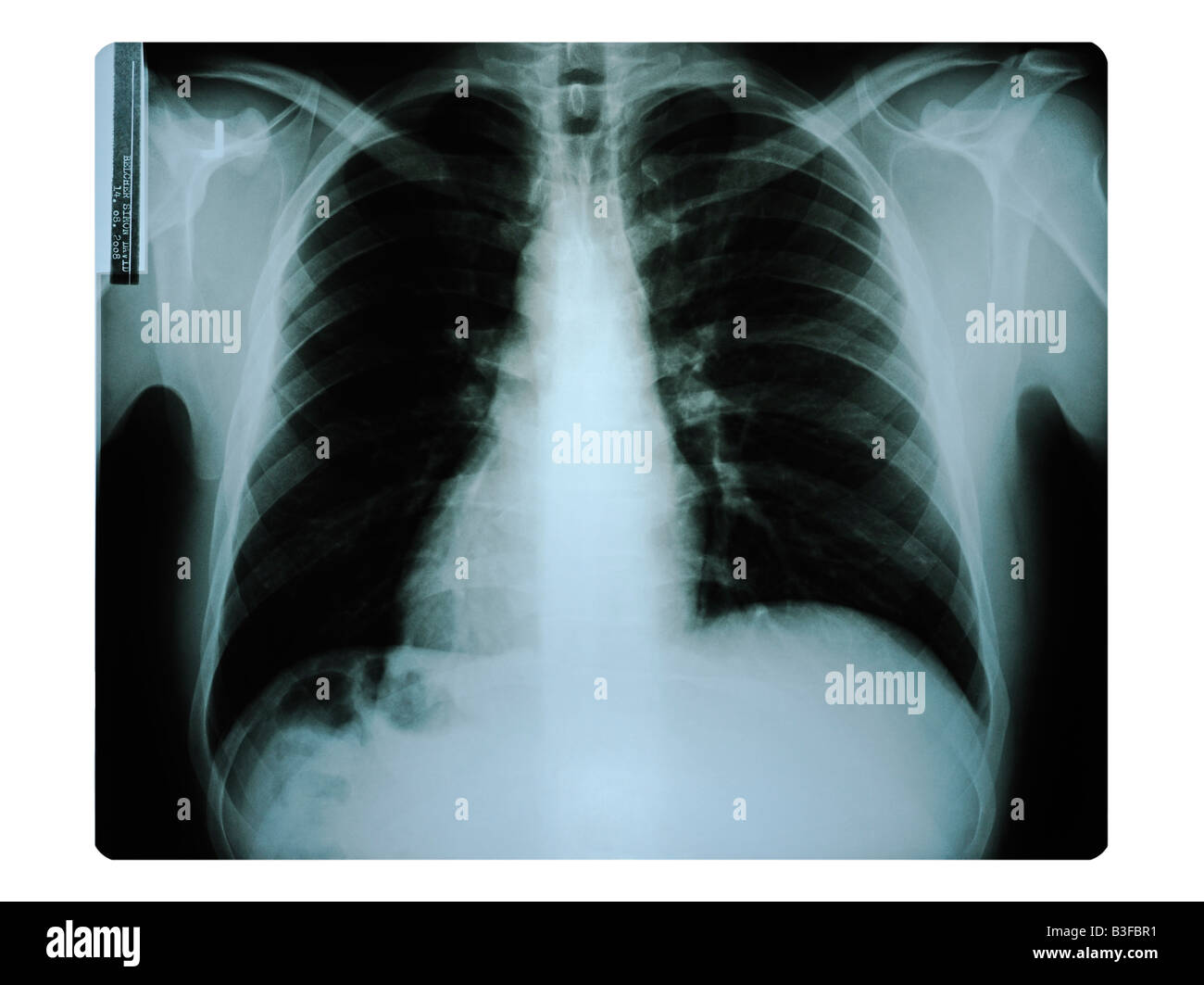 Adult male chest x ray Cut Out Stock Images & Pictures - Alamy