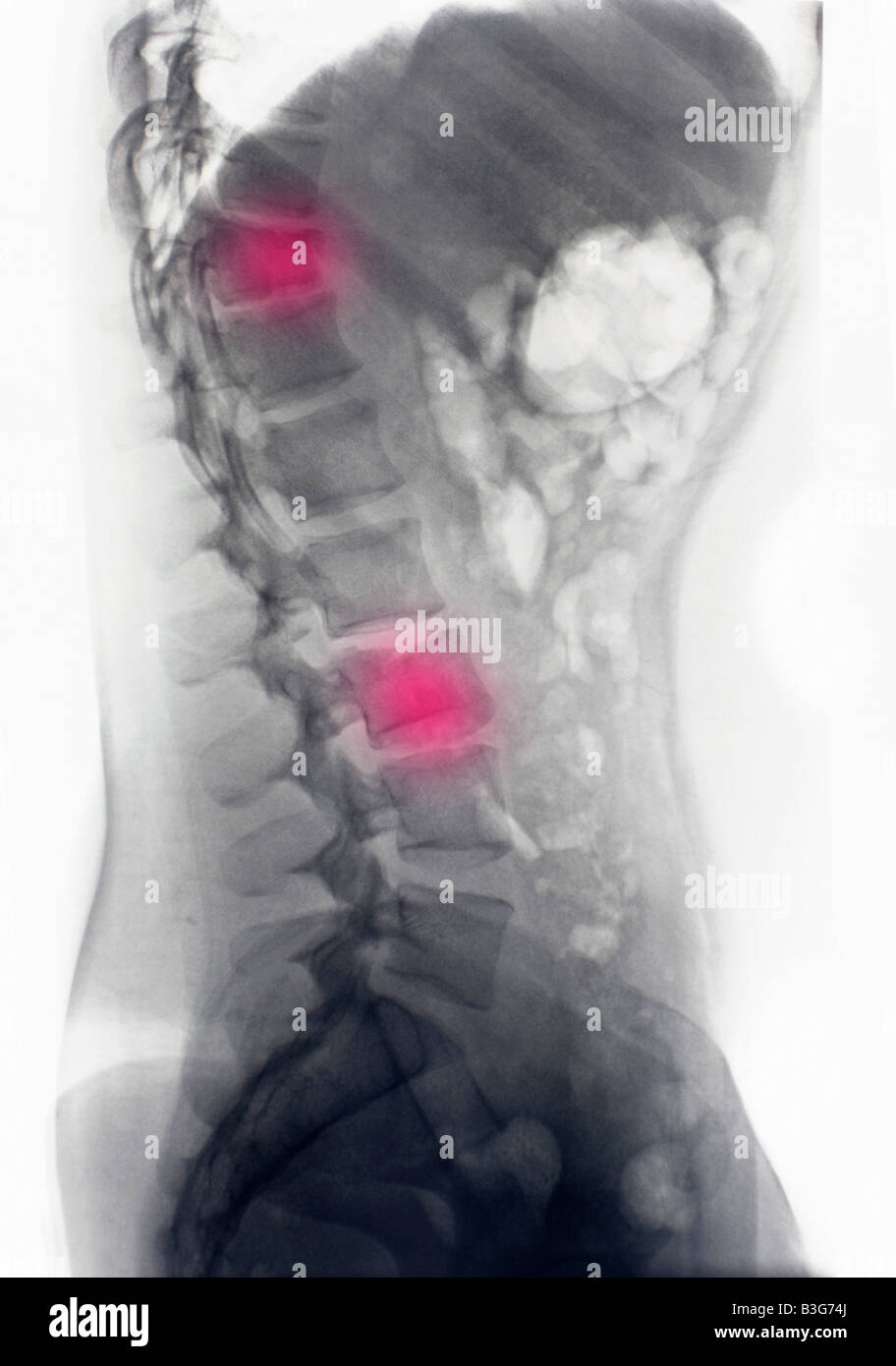CT scan of a 16 year old female patient involved in motor vehicle crash ...