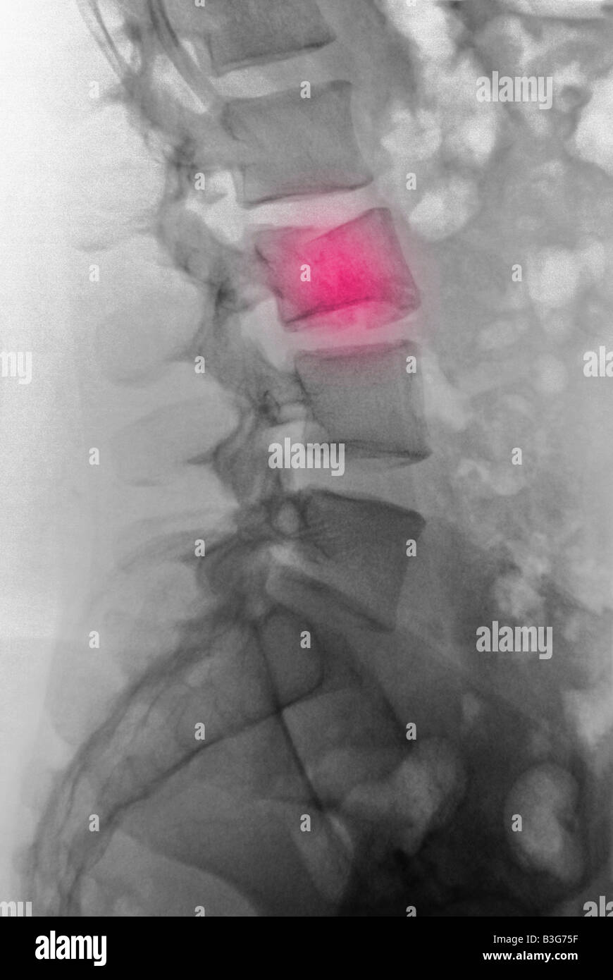 Compression fracture spine hi-res stock photography and images - Alamy