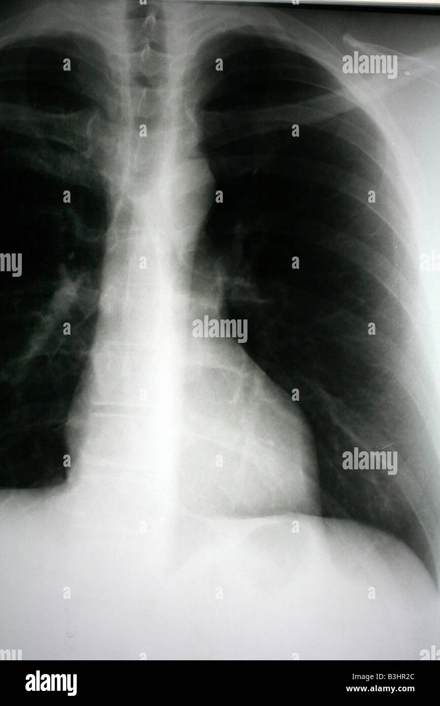 X-ray of the lung Stock Photo - Alamy