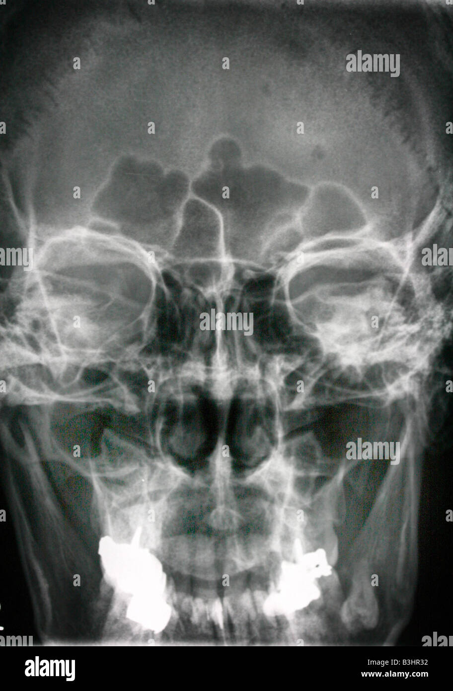 X-ray of the head Stock Photo - Alamy