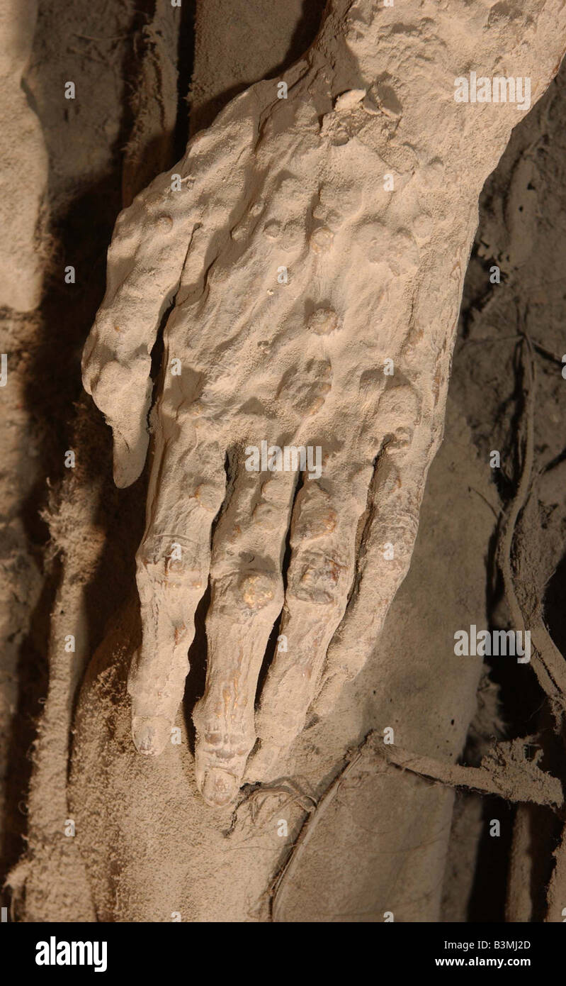 400 year old mummified remains with skin nails and warts still intact ...