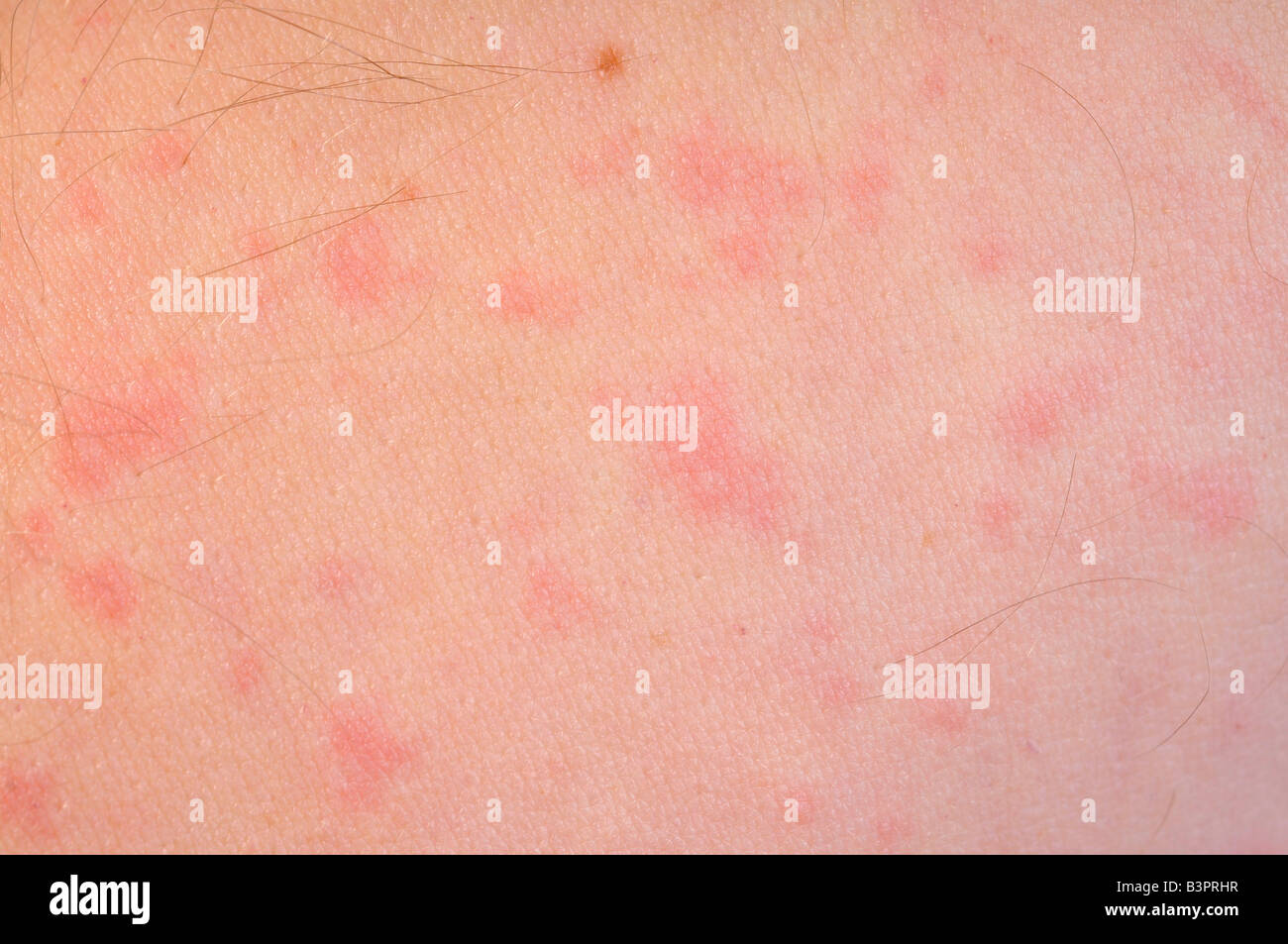 Penicillin allergy rash hi-res stock photography and images - Alamy