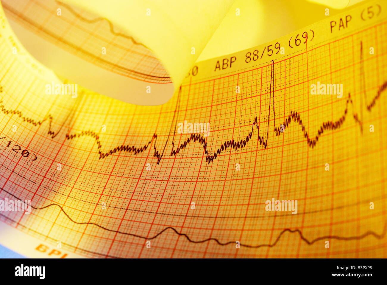 Ecg Graph Stock Photos & Ecg Graph Stock Images - Alamy