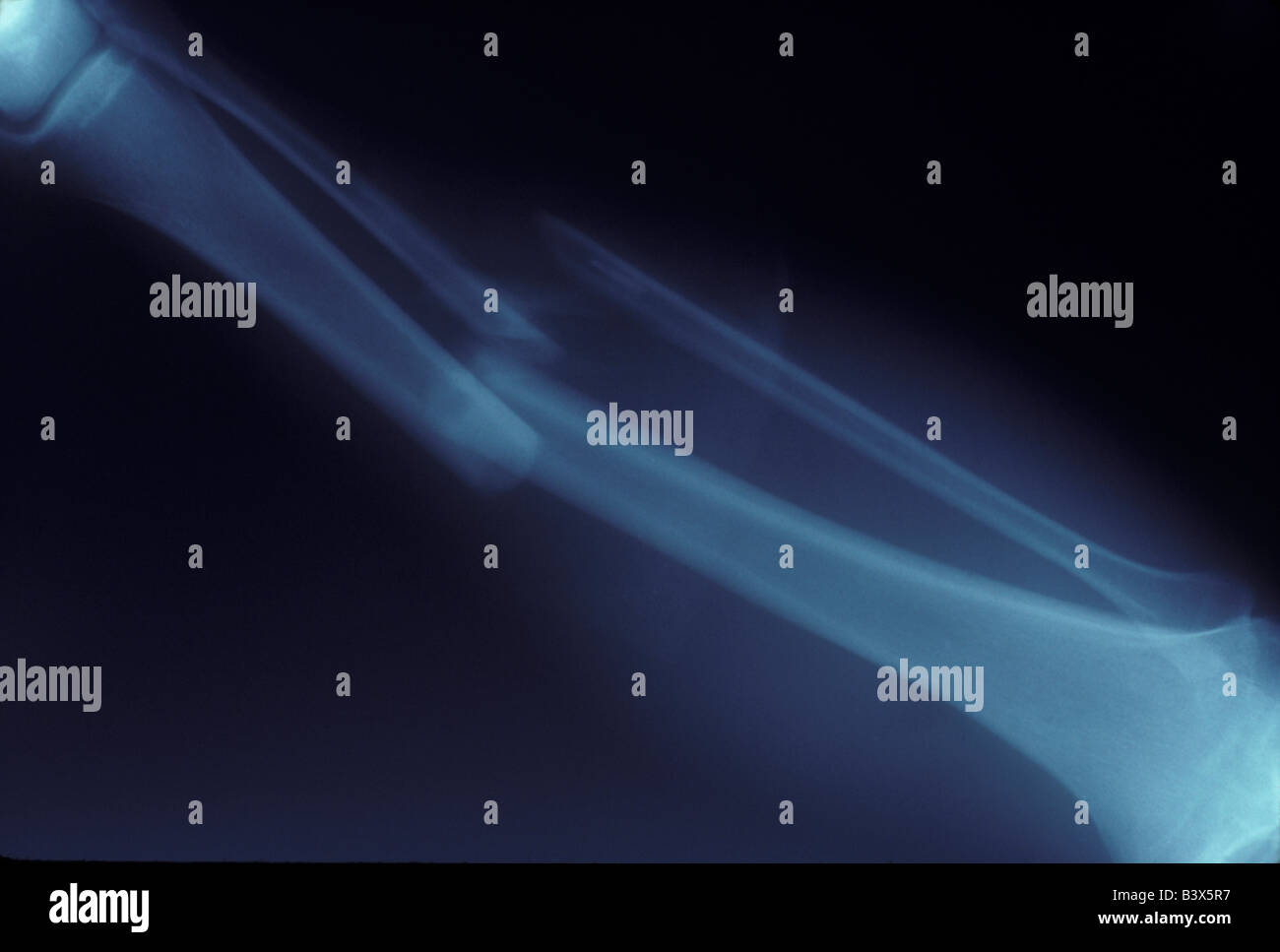 Broken leg x ray hi-res stock photography and images - Alamy