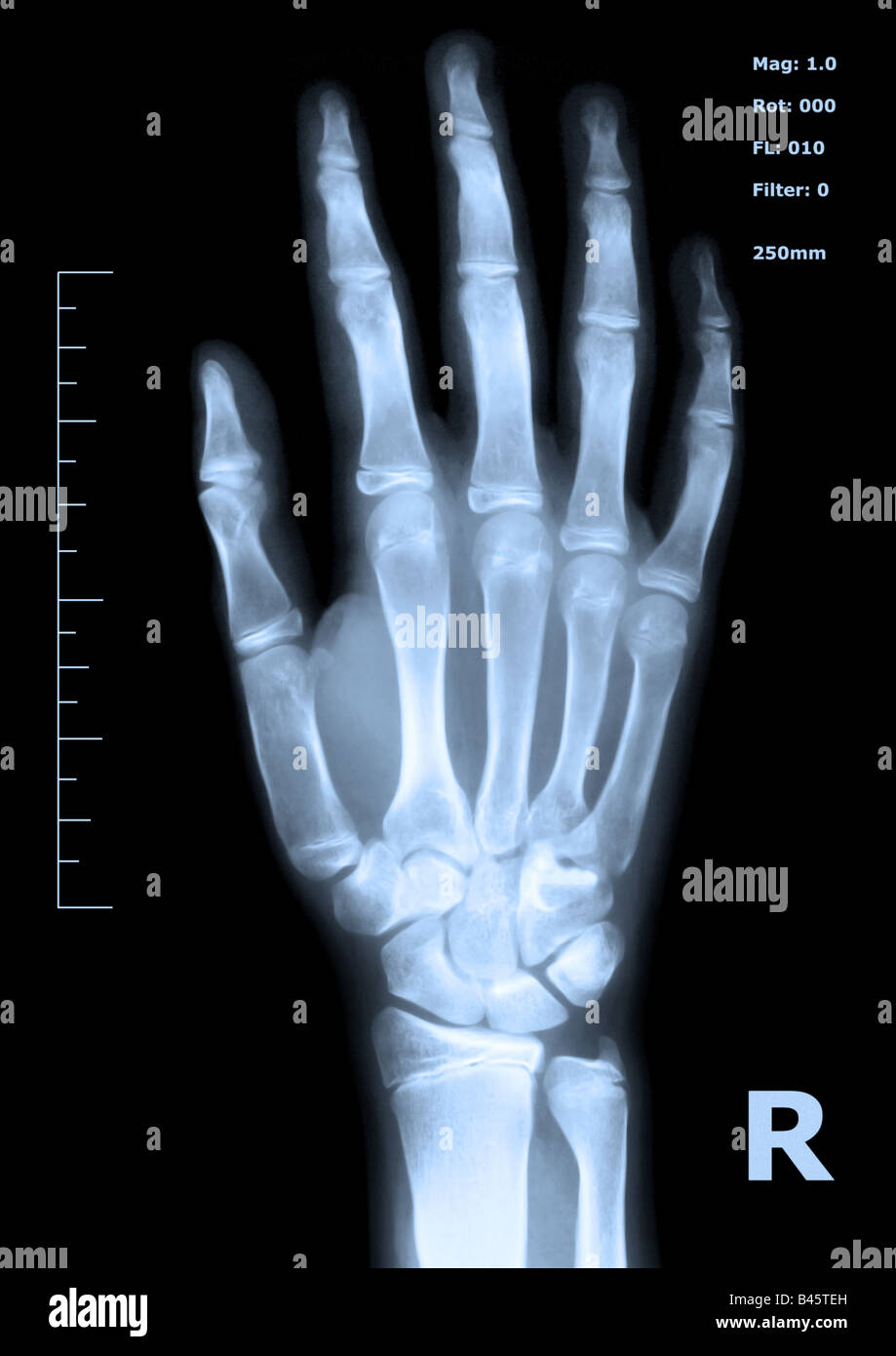 X ray of a human hand Stock Photo - Alamy