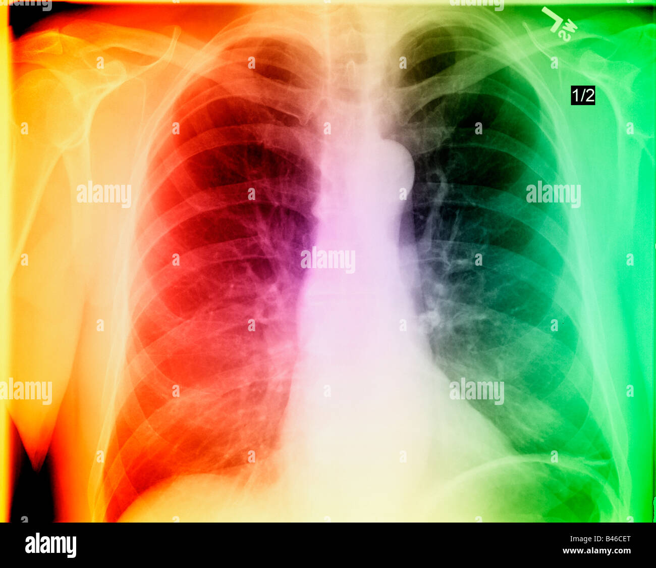 Chest x ray colored hi-res stock photography and images - Alamy