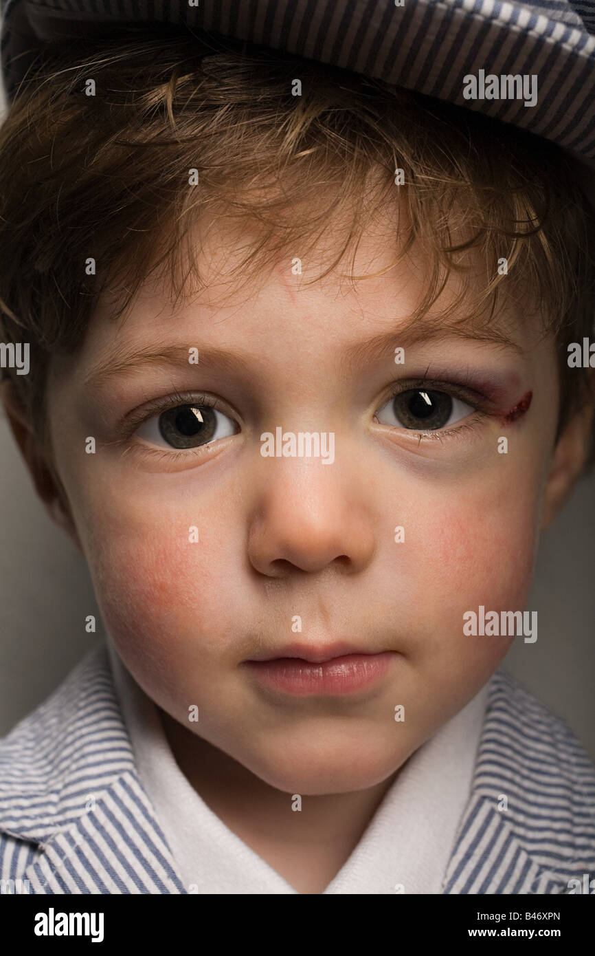 Boy with an injury Stock Photo - Alamy