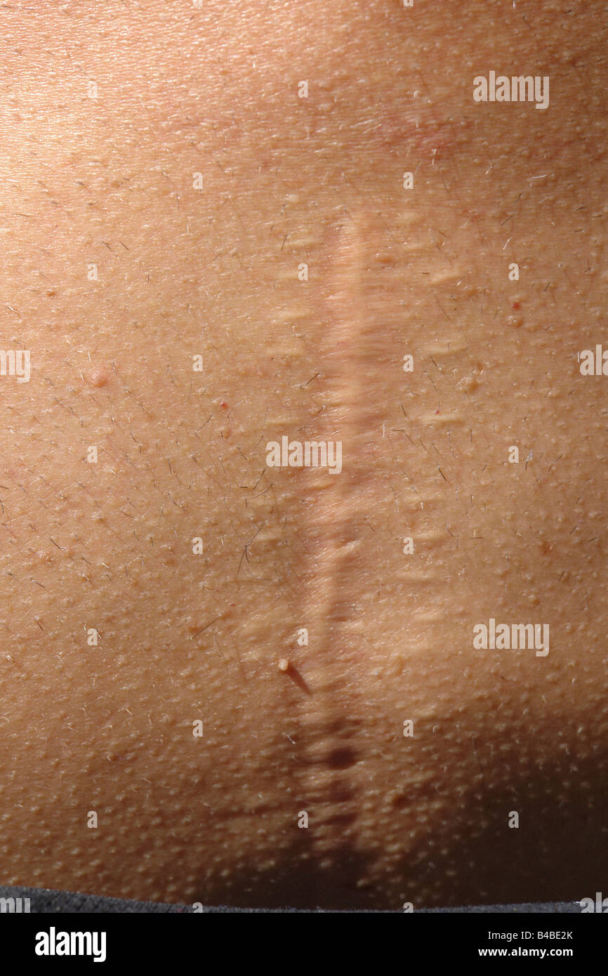 Spinal cord injury scar hi-res stock photography and images - Alamy