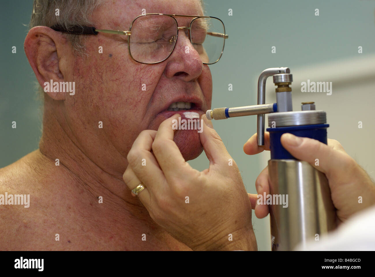 Freezing skin cancer hi-res stock photography and images - Alamy