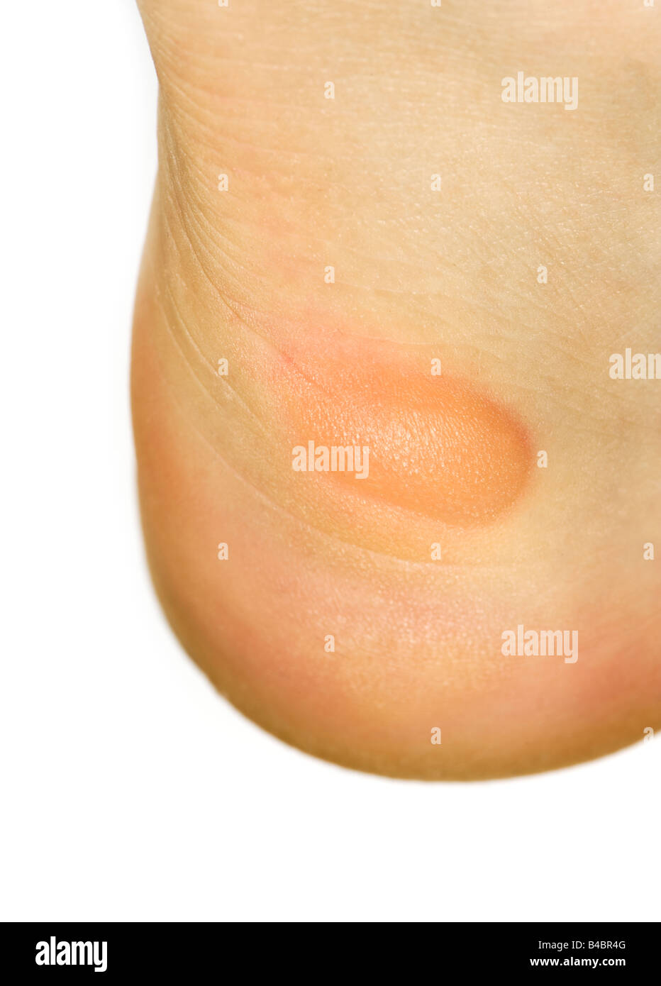 Blister foot hi-res stock photography and images - Alamy
