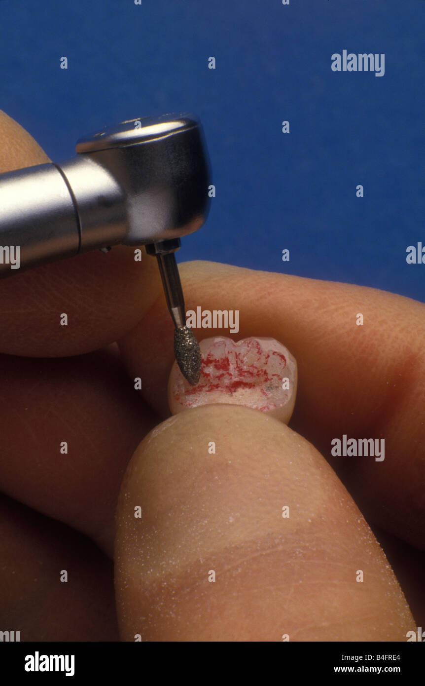 dental tooth drilling Stock Photo - Alamy