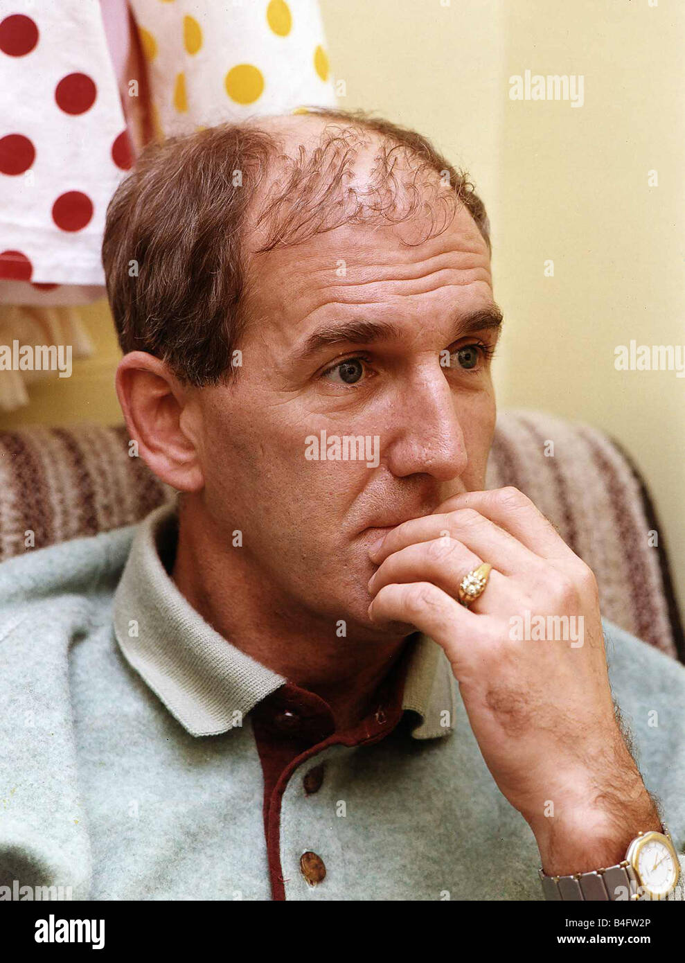 Russ Abbot in a theatre dressing room shows his Hair Transplant Stock ...