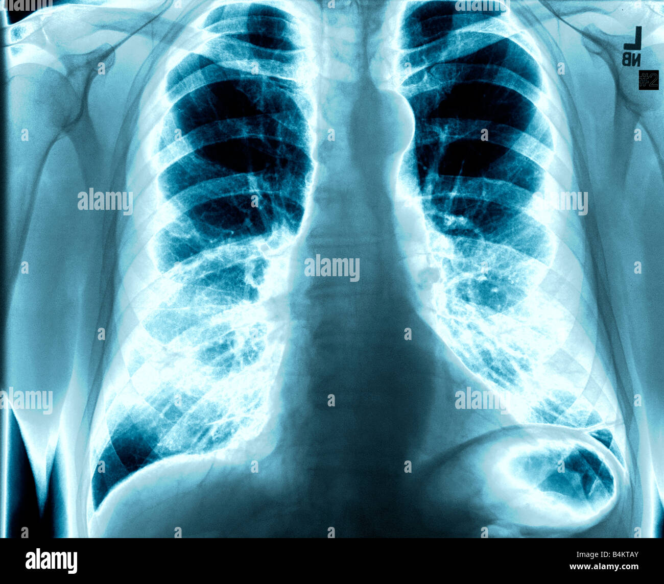 chest X-ray projected on large screen Stock Photo - Alamy