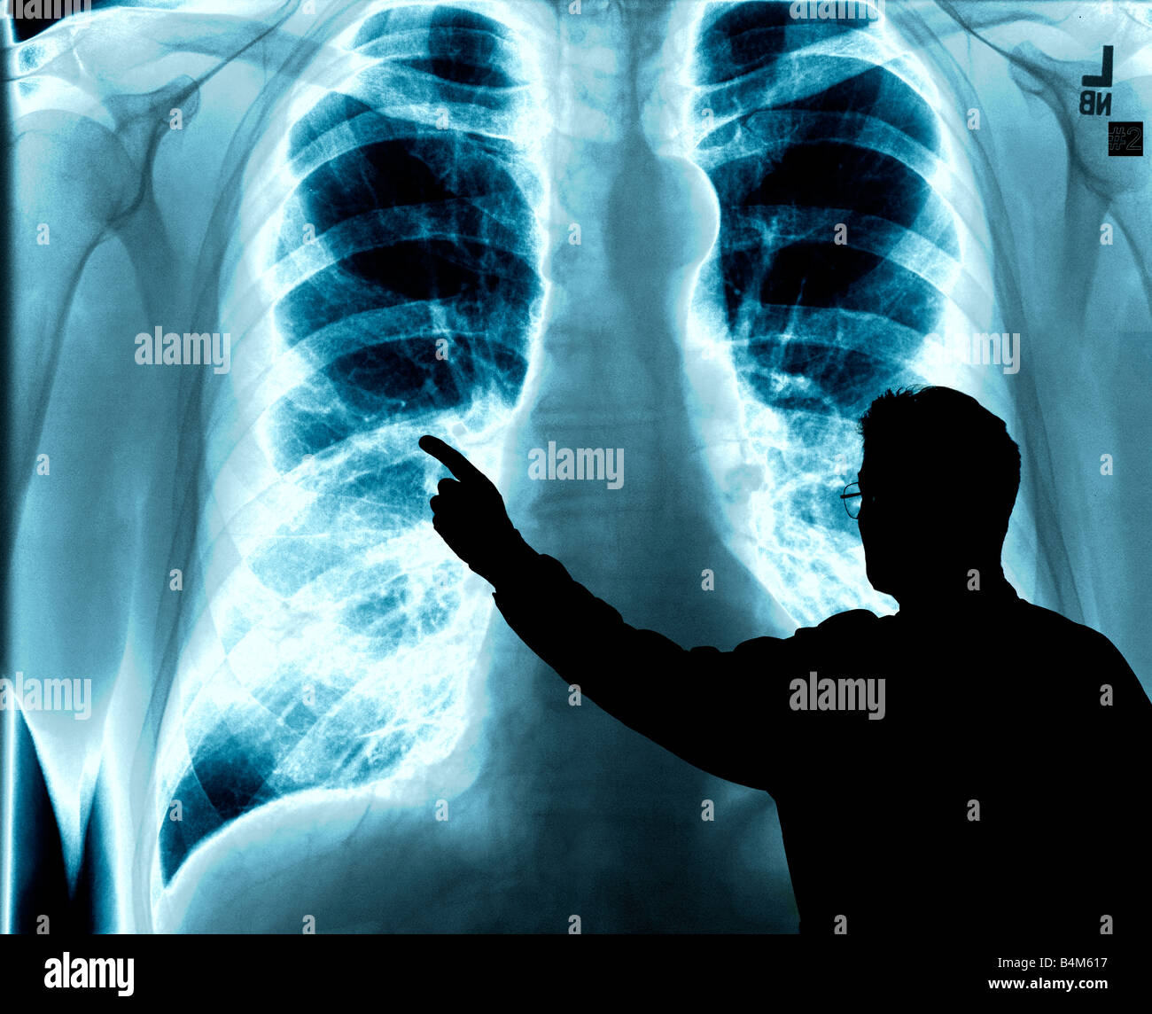Chest x ray doctor hi-res stock photography and images - Alamy