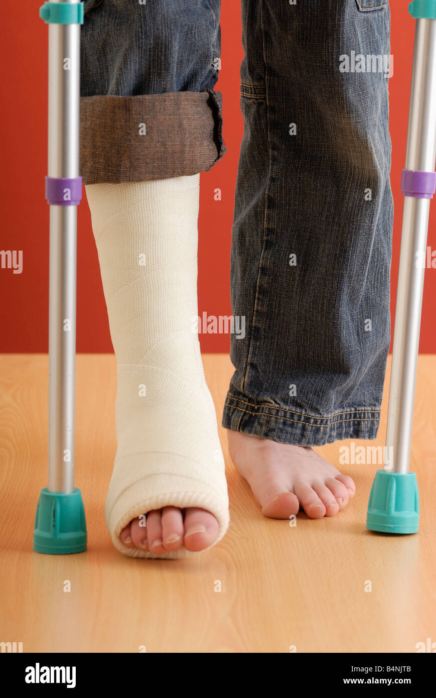 Leg in plaster hi-res stock photography and images - Alamy