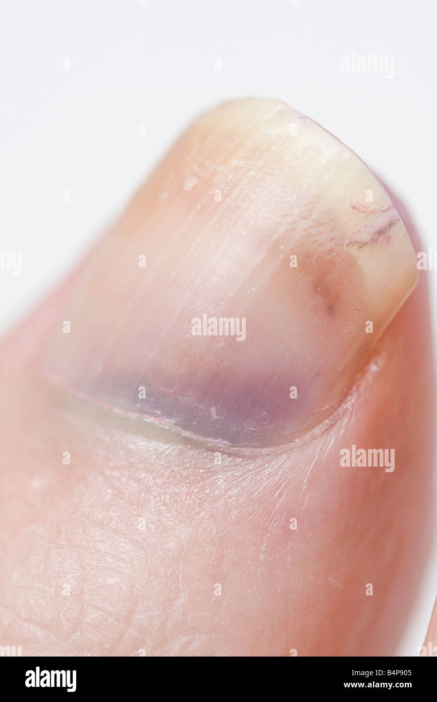 Bruised Toe Stock Photos & Bruised Toe Stock Images - Alamy