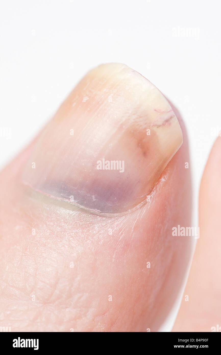 Bruised Toe Stock Photos & Bruised Toe Stock Images - Alamy