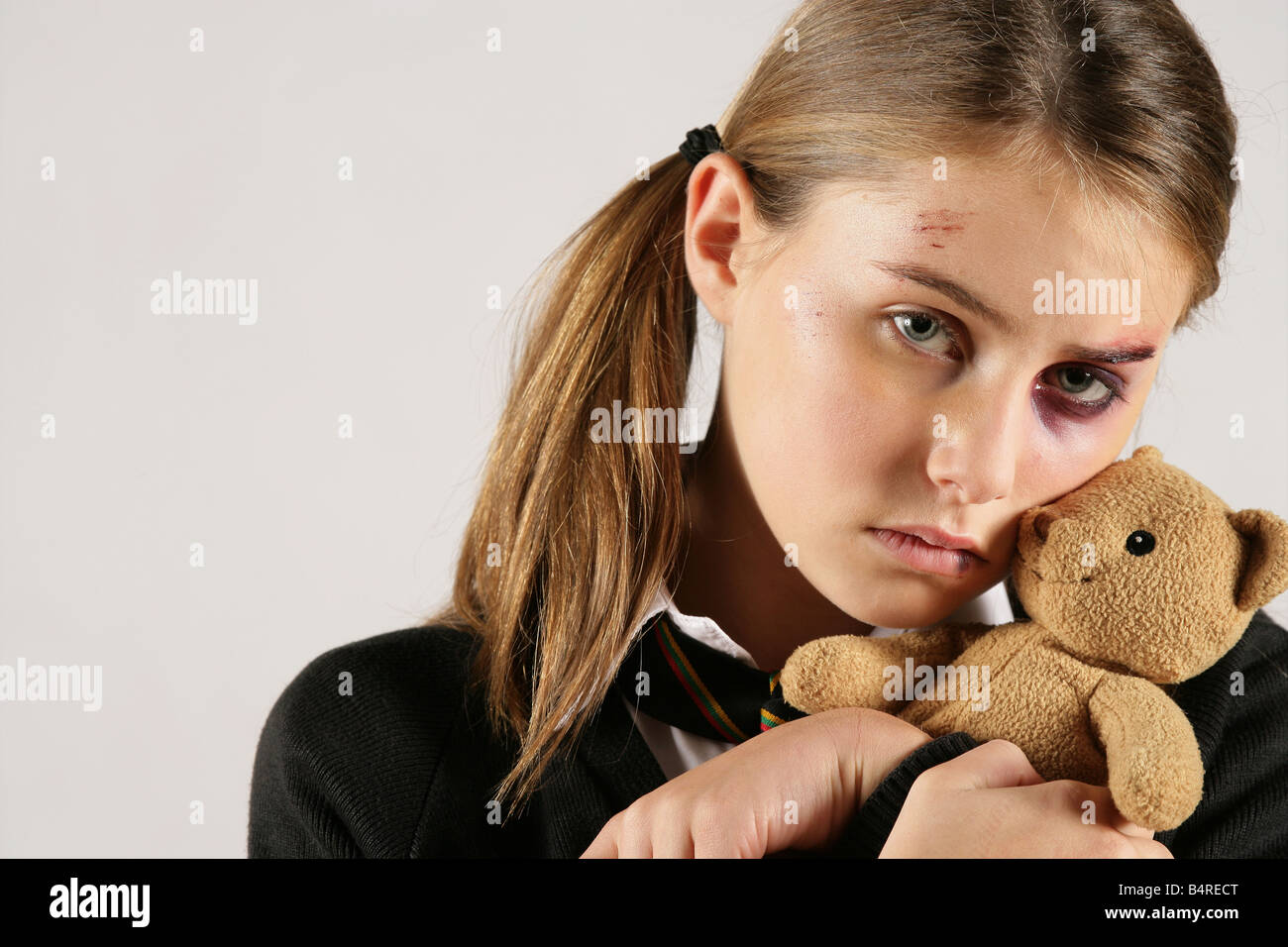 “School girl with a black eye and facial injuries posed by model ...