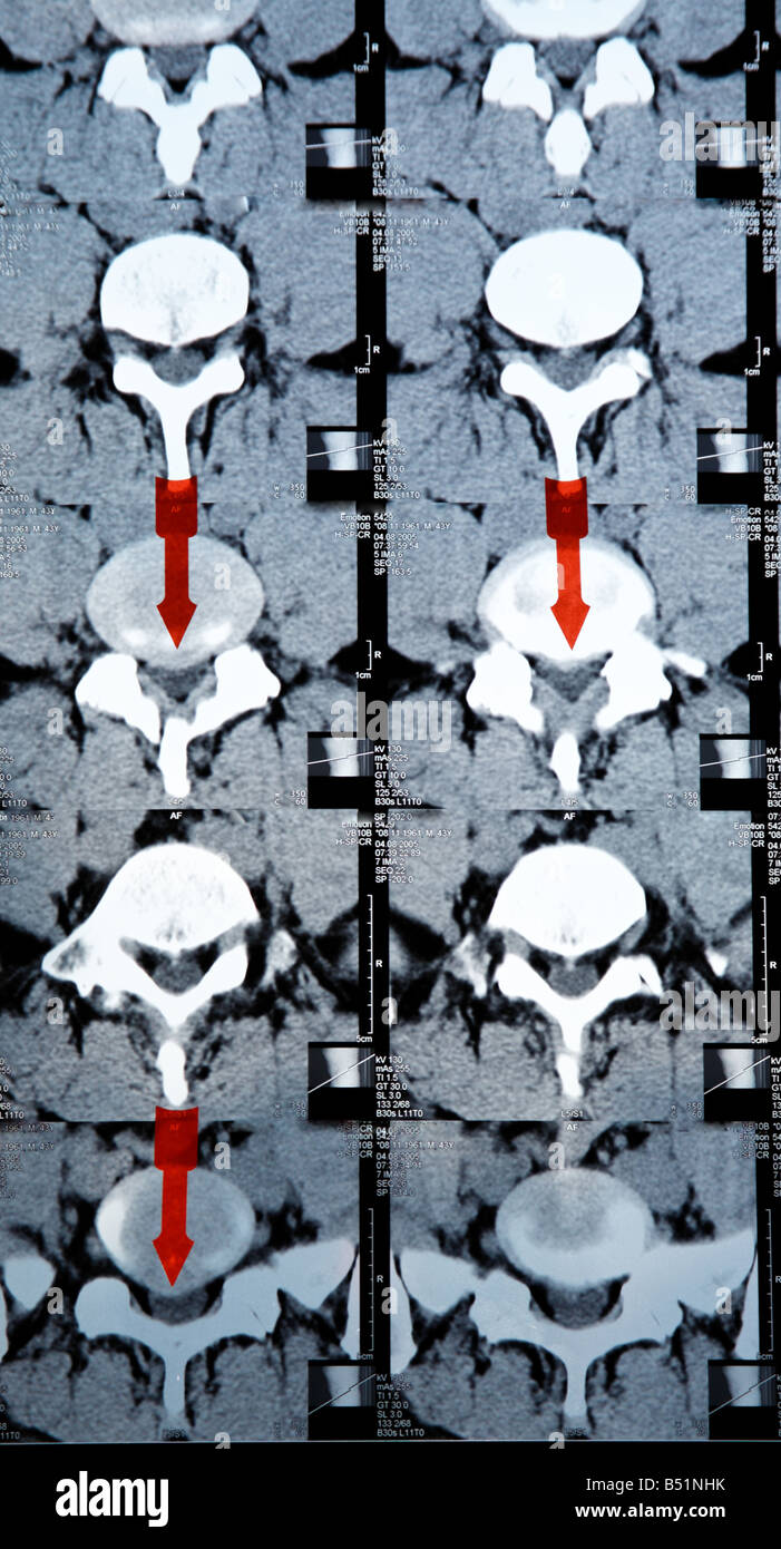An X-ray of a disc prolapse Stock Photo - Alamy