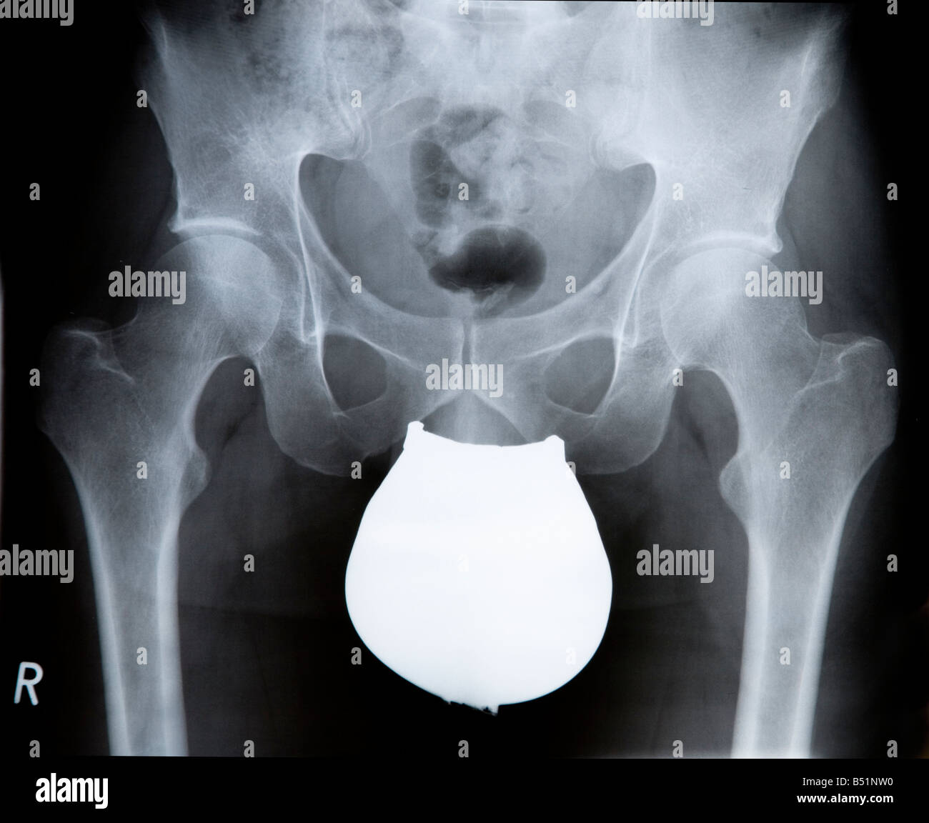 x-ray of a hip Stock Photo - Alamy