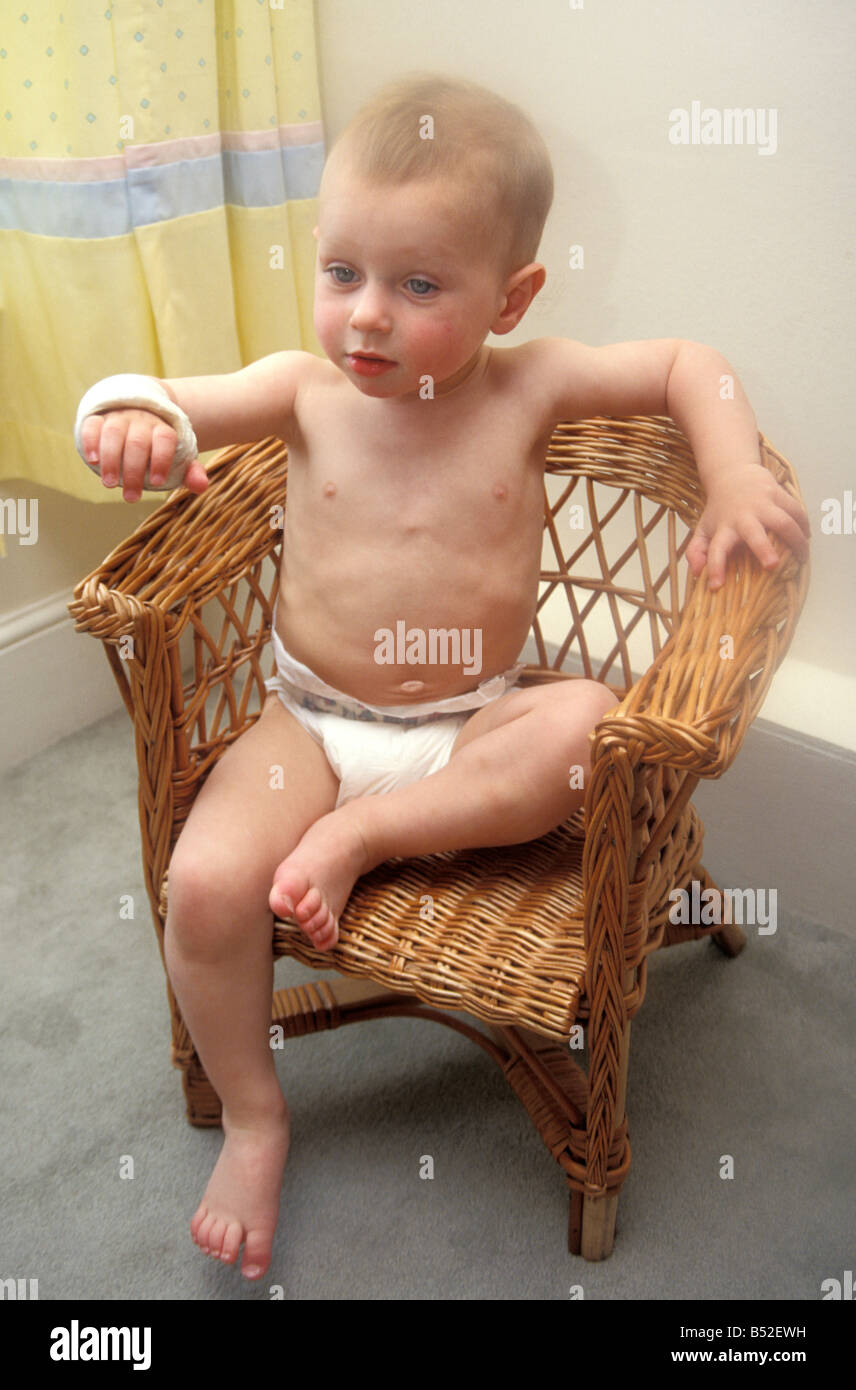 toddler with broken arm in cast sitting in child s wicker chair Stock ...
