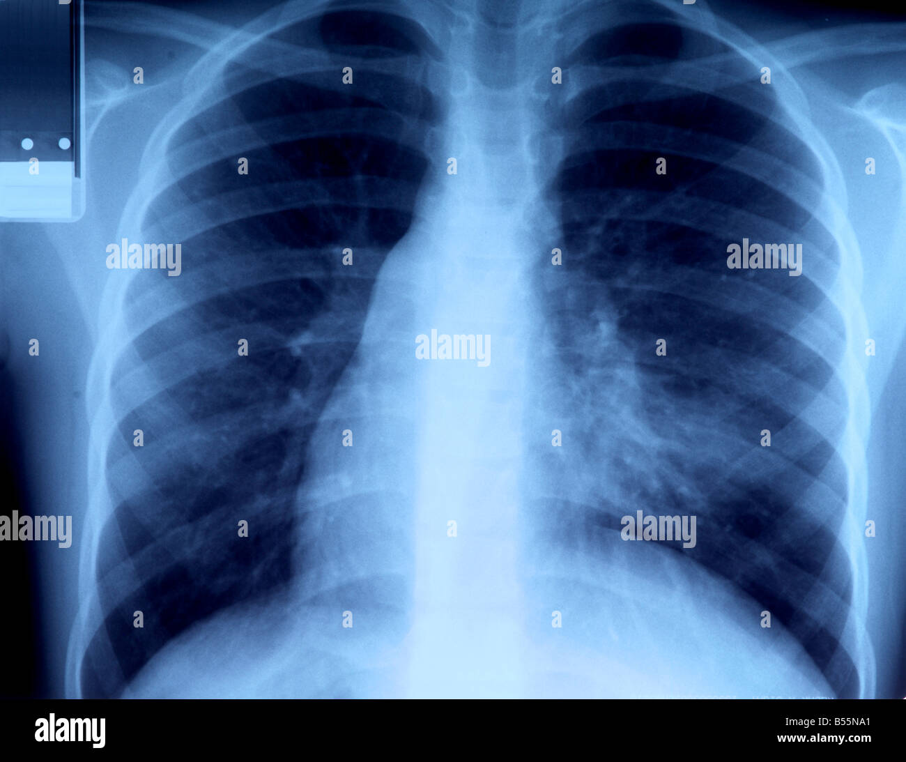radiography of chest Stock Photo - Alamy