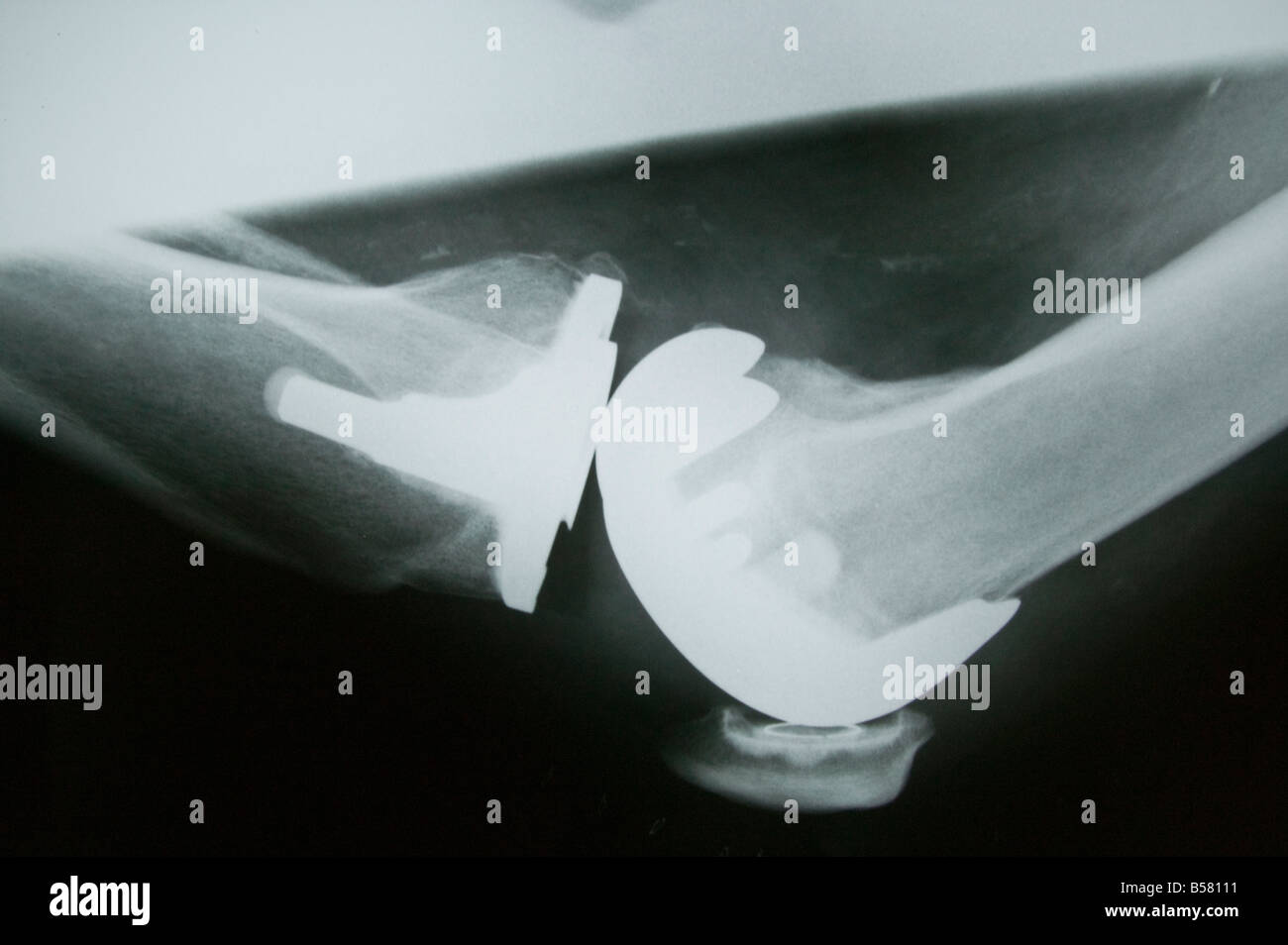 X-ray of 'Total knee arthroplasty' prosthesis Stock Photo - Alamy