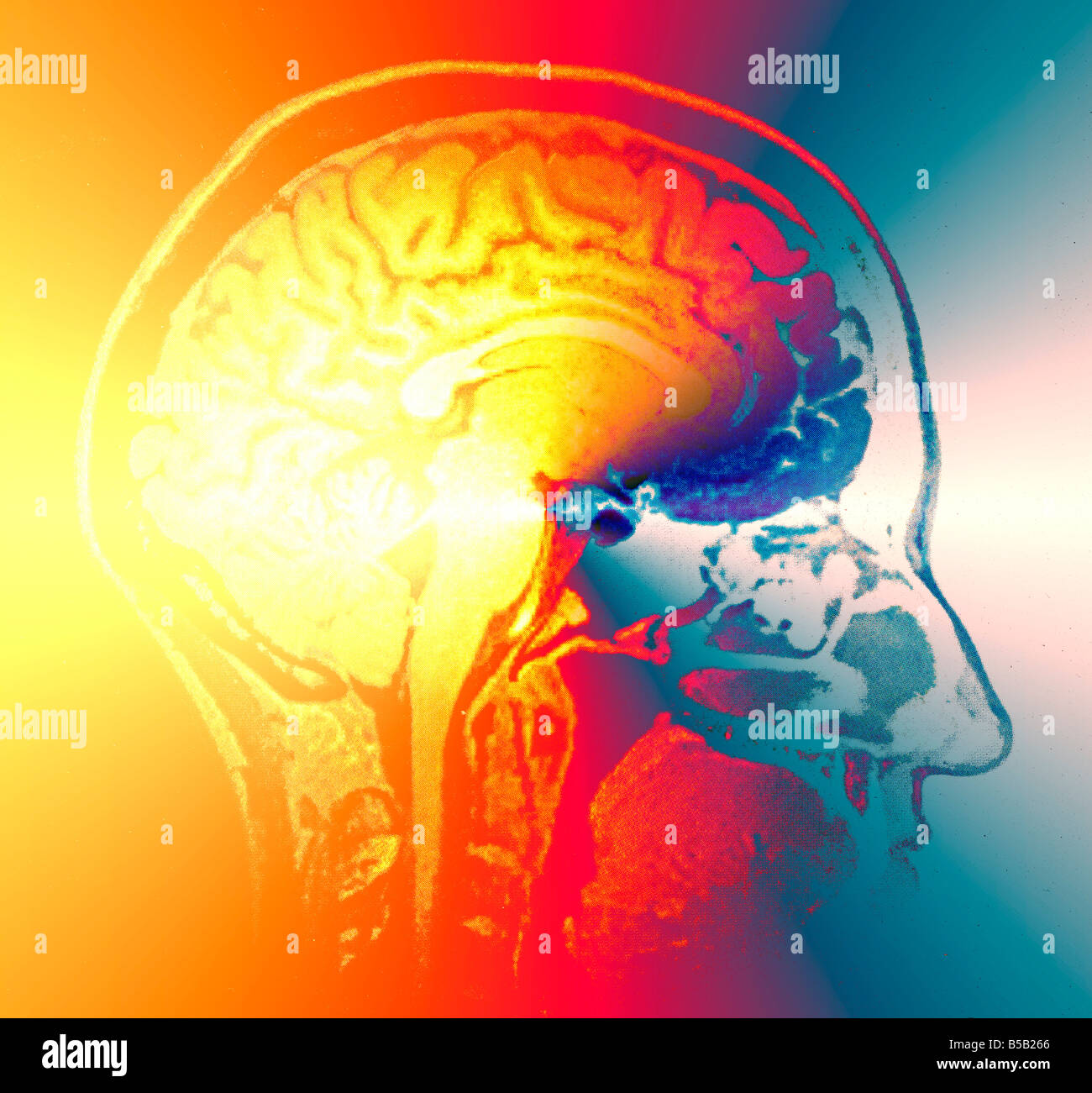 Color coded MRI scan of human head Stock Photo - Alamy