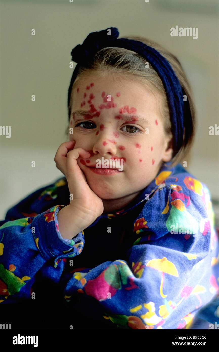 little girl with buttons of chicken pox on the face Stock Photo - Alamy