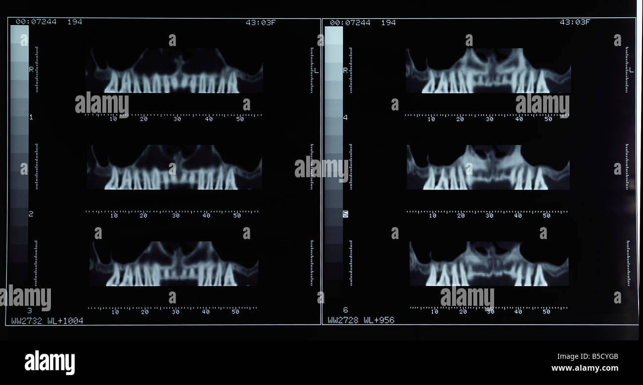 dental scan radiography Stock Photo - Alamy