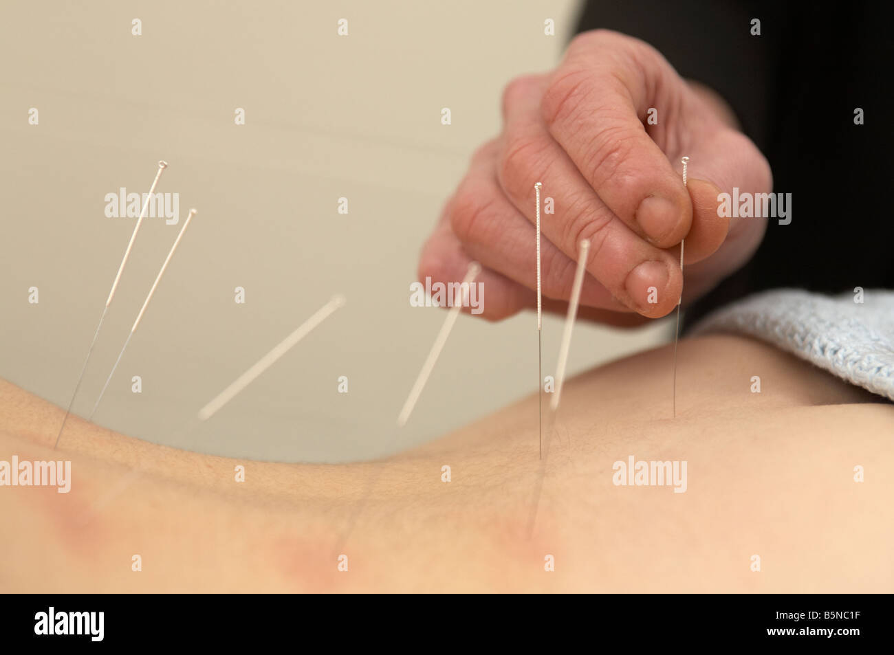 female acupuncturist applying acupuncture needles to the lower back of ...