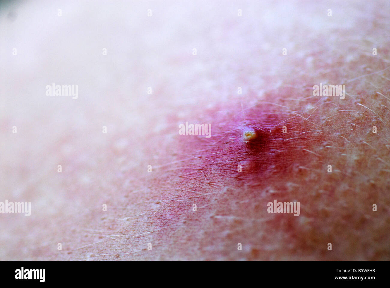 Inflamed skin hi-res stock photography and images - Alamy
