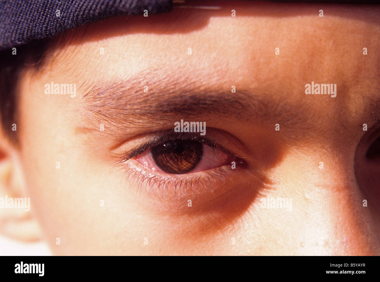 Close-up view of Hispanic boy's eye suffering from the disease called ...