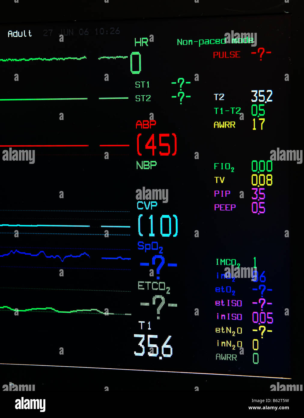 Hospital chart heart monitor hi-res stock photography and images - Alamy