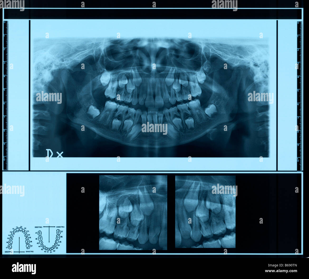 Radiography child denture hi-res stock photography and images - Alamy