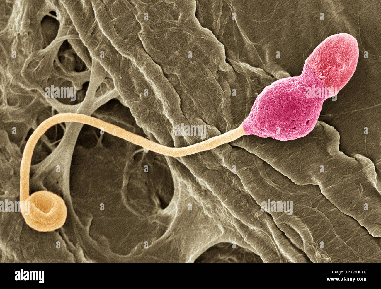 Deformed sperm cell, coloured scanning electron micrograph (SEM Stock ...
