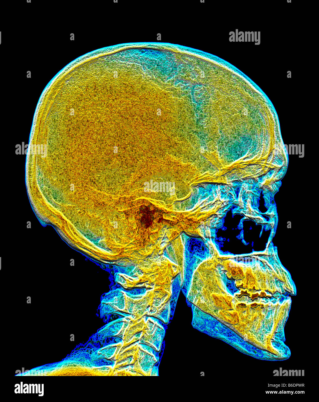 Human skull, coloured X-ray Stock Photo - Alamy