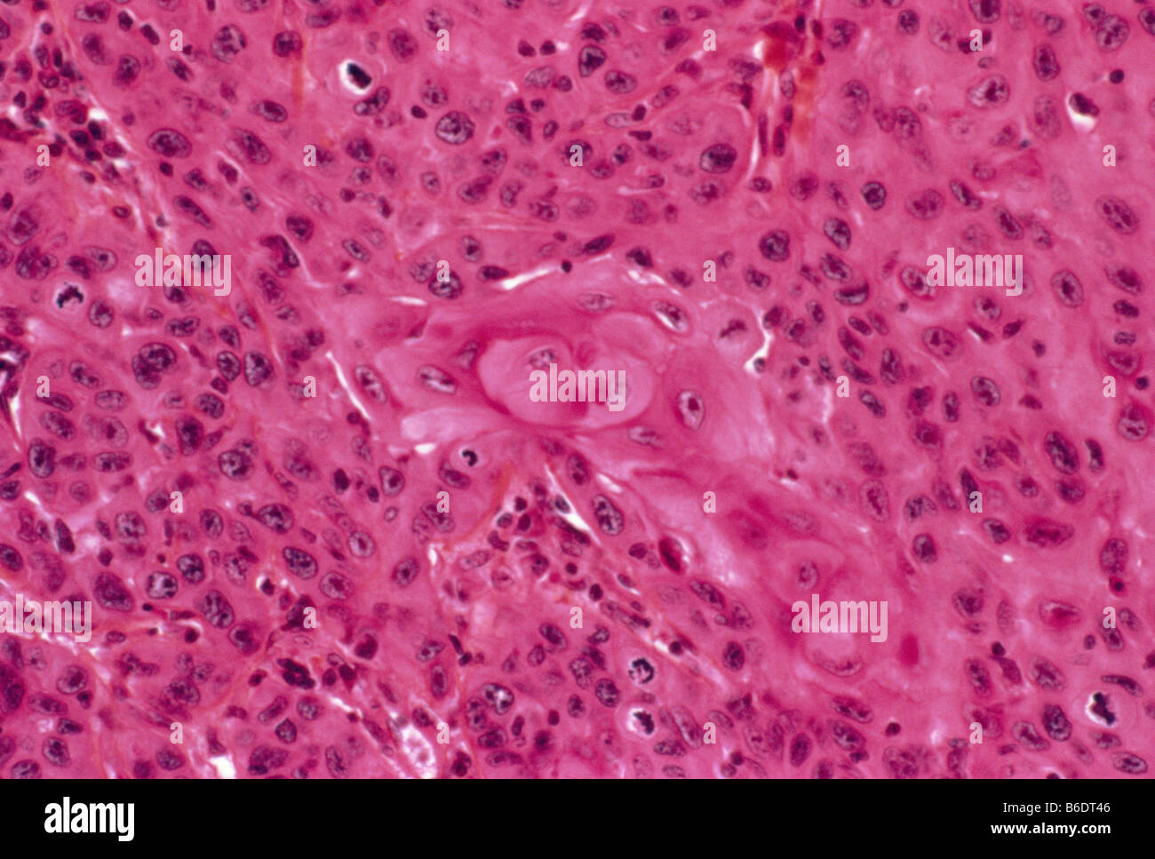Skin cancer Light micrograph of a section through an epidermoid ...