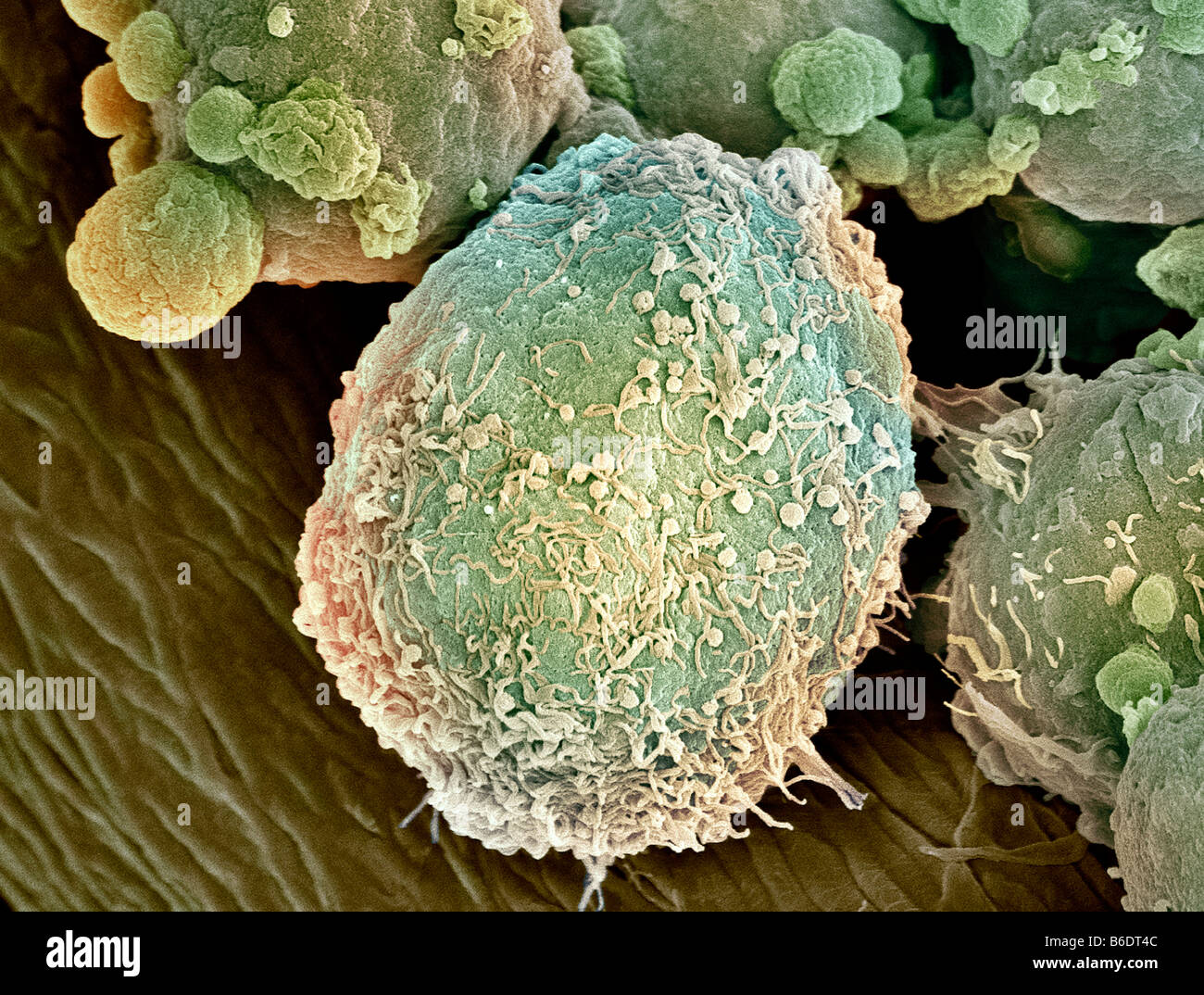 Lymphoma lymph cell Coloured scanningelectron micrograph (SEM) of a ...