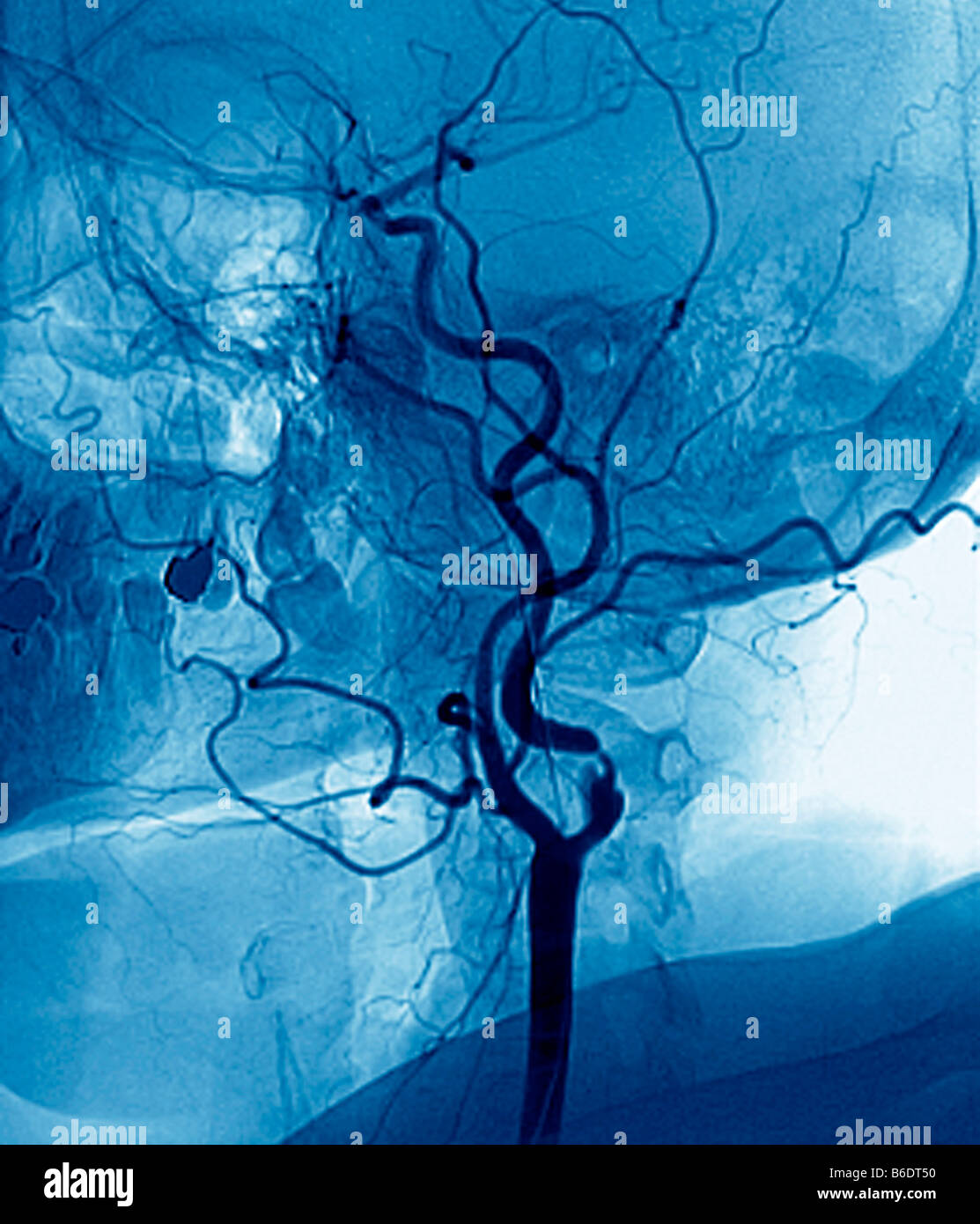 Narrowed neck artery. Coloured angiogram of the left carotid artery ...