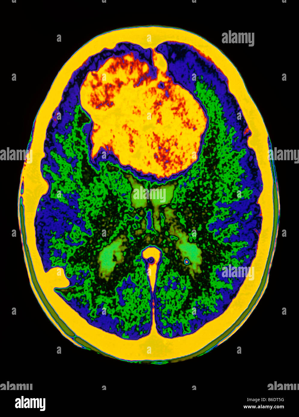 Meningioma High Resolution Stock Photography and Images - Alamy