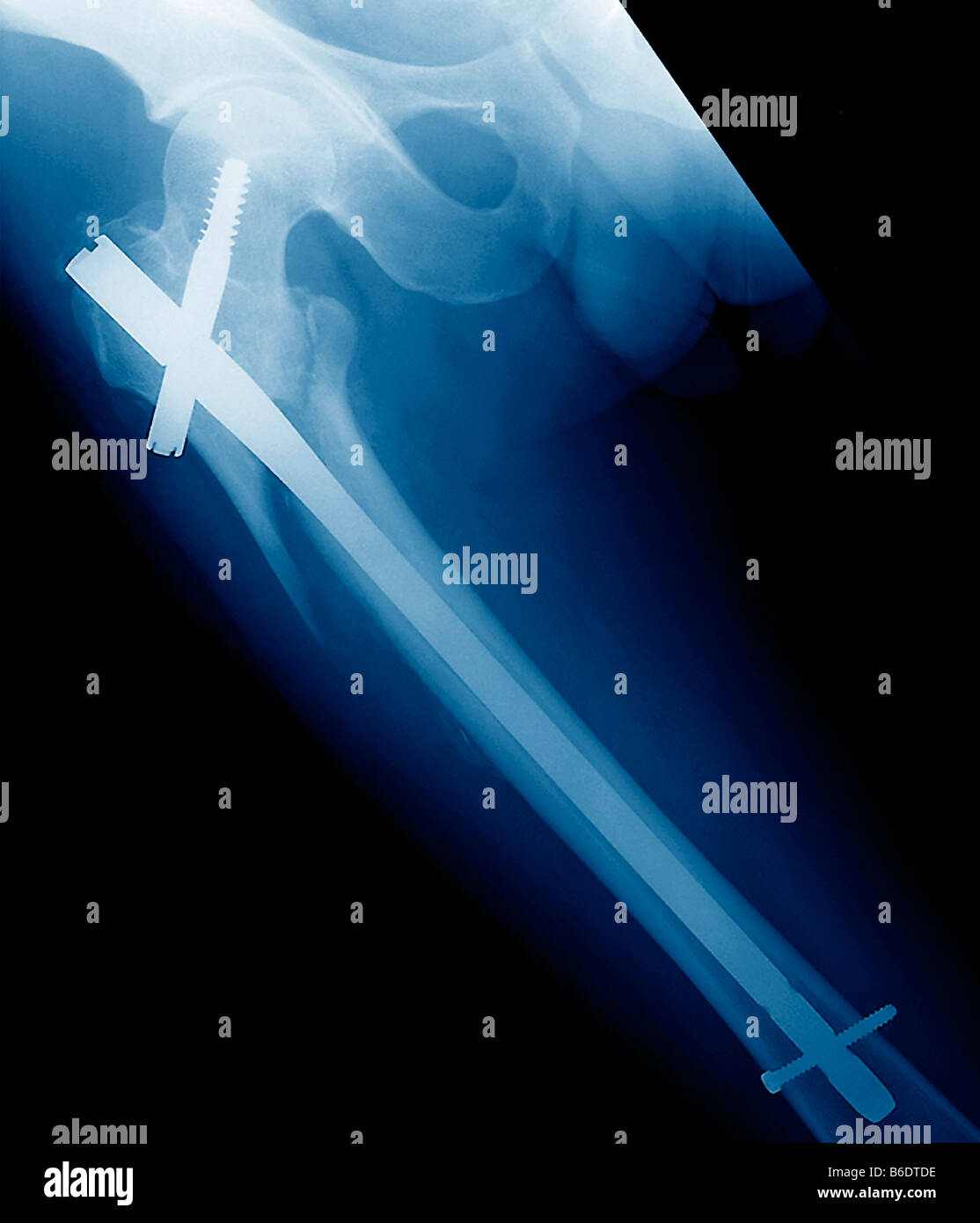 Broken thigh bone hi-res stock photography and images - Alamy