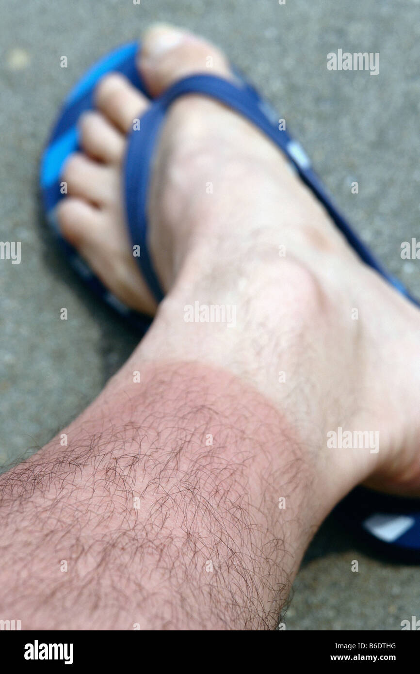 Selective Focus Photograph of a Man's Sunburned Tanned Leg and Foot He ...