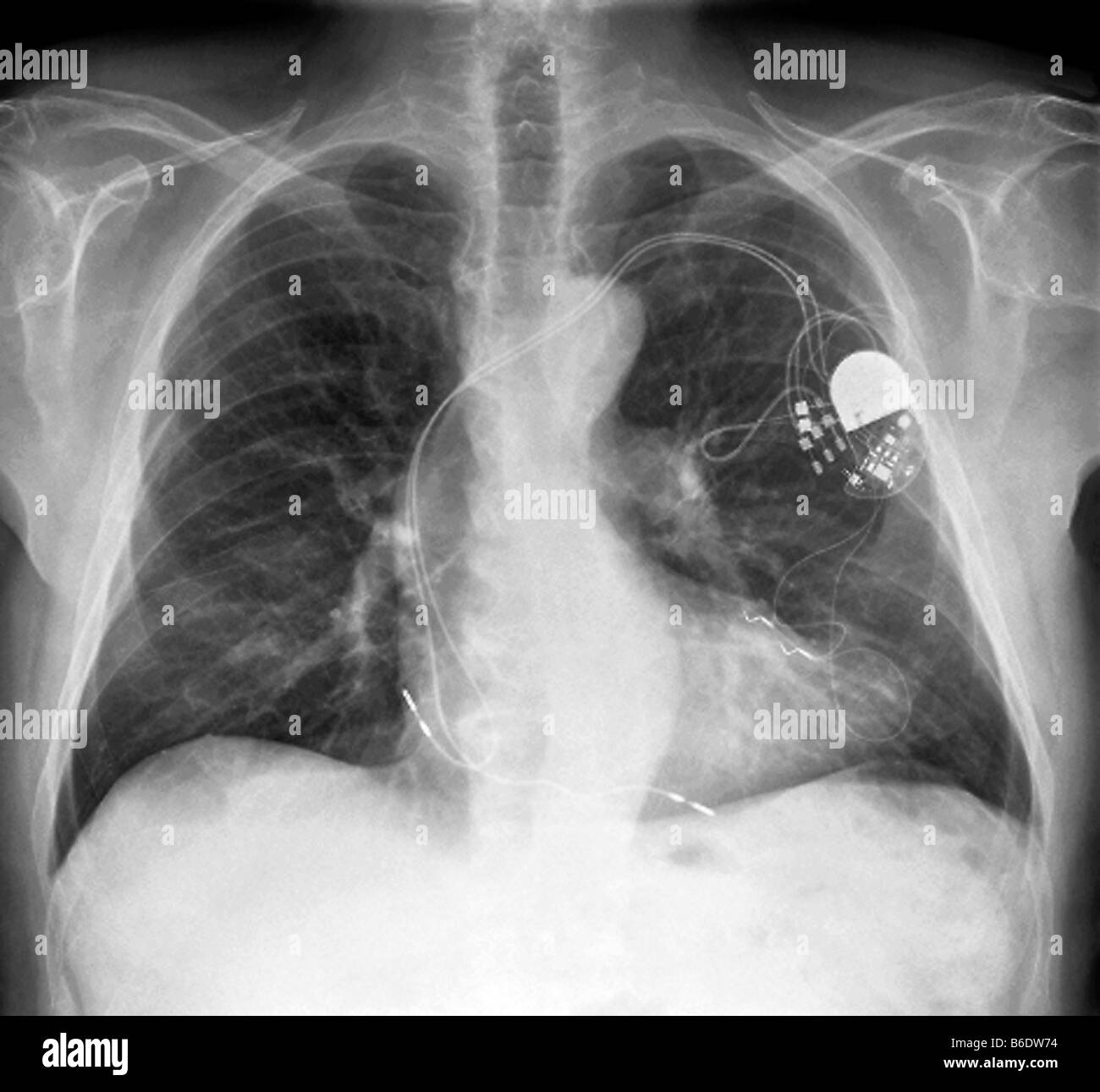 Heart pacemaker. Frontal X-ray of the chest of a 64 year old patient ...